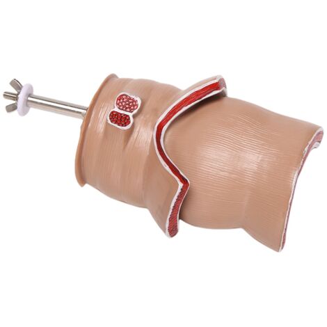 Modelo anatómico de lesión hemorroidal rectal humana. Modelo de fístula ...